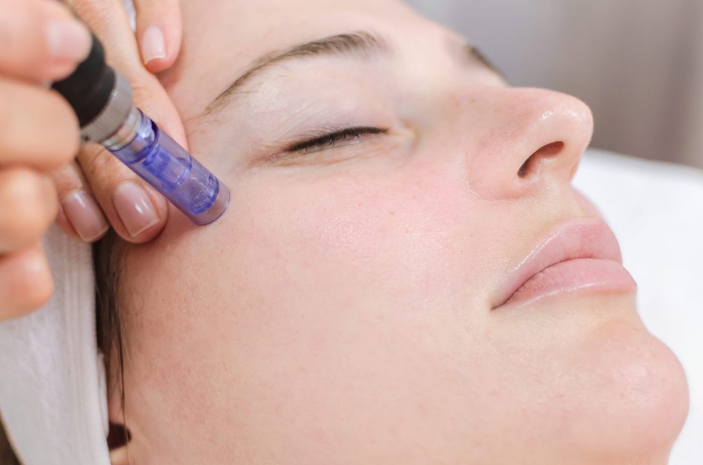 What does Micro-needling do for your face? - Alchemy West