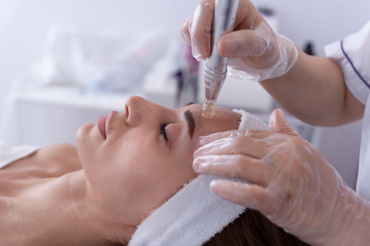 Unlock Youthful Skin: The Microneedling Marvel